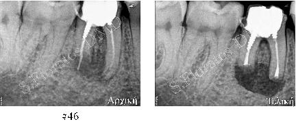 Modern Microsurgery - Endodontics treatments / Root canal treatments ...
