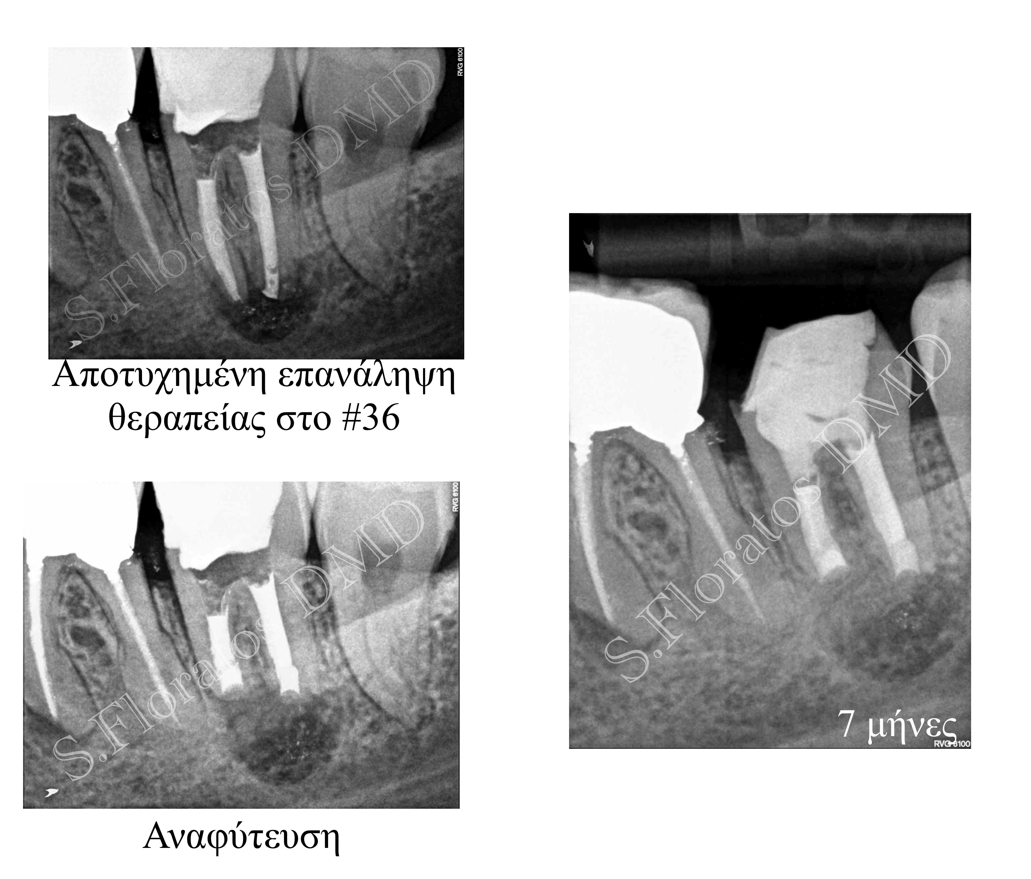 Modern Microsurgery - Endodontics treatments / Root canal treatments ...