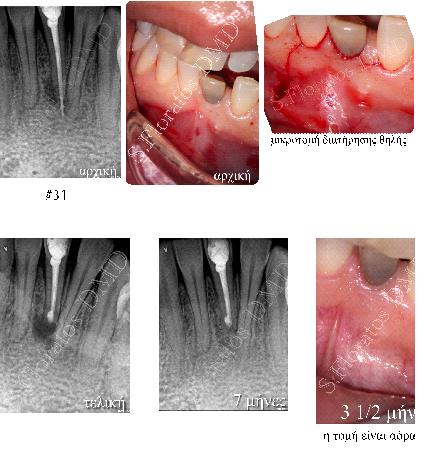 Modern Microsurgery - Endodontics treatments / Root canal treatments ...
